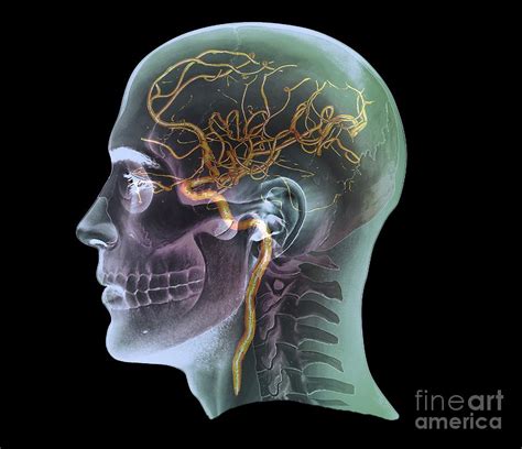 Internal Carotid Artery 3d Ct Scan Photograph By Zephyr