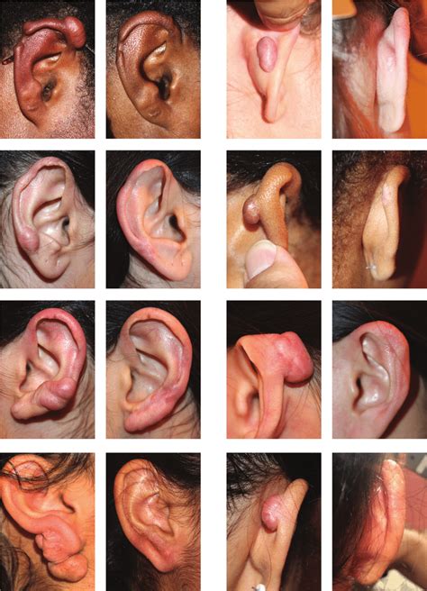 Successful Keloid Removal With Contact Cryotherapy For Small Primary Download Scientific