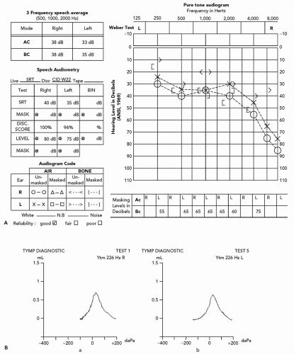 Sensorineural Hearing Loss Tympanogram