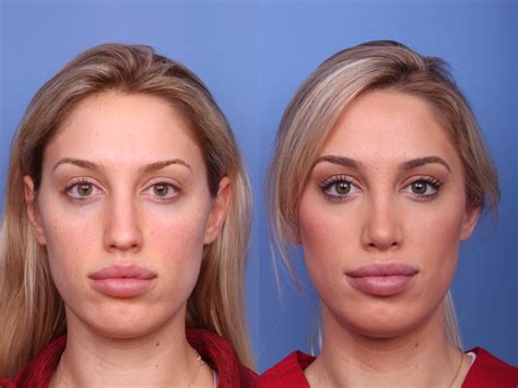 Best Rhinoplasty For Scottsdale And Phoenix Az Dr Todd Hobgood