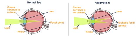 Astigmatism Explained Clearly Causes Symptoms And Effective