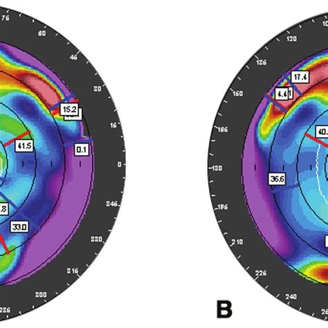 A Two Corneal Epithelial Defects With Diffuse Punctuate Epithelial