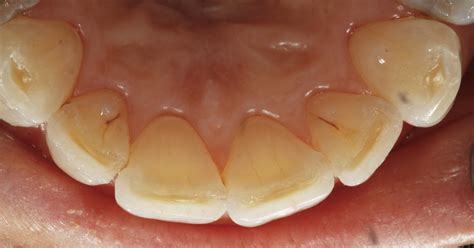 What Is Enamel Abrasion At Tamara Juarez Blog