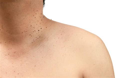 What Are Seborrheic Keratoses And How Are They Treated Duncan