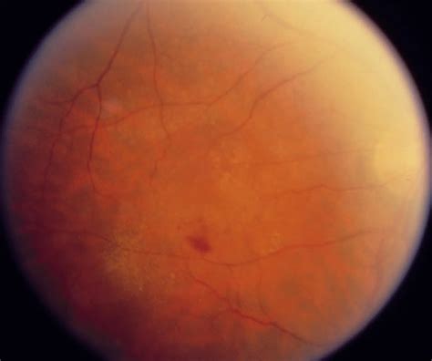 Pigmented Epithelial