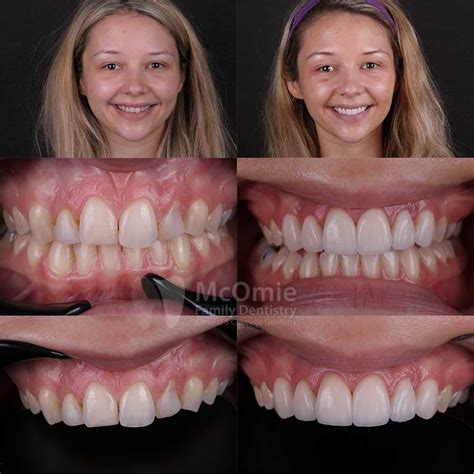 Veneers Before And After Buck Teeth At Donna Hammonds Blog