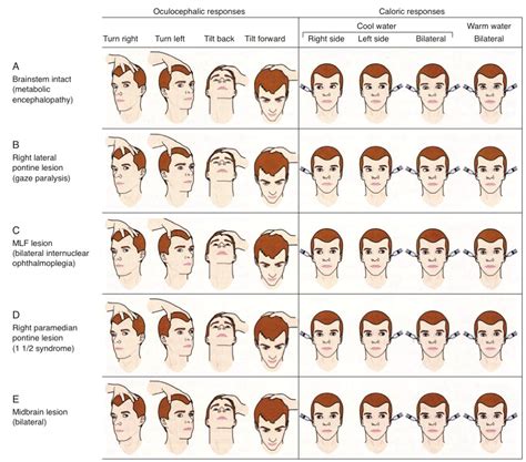 Vestibulo Ocular Reflex Wikipedia