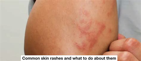 Common Skin Rashes And What To Do About Them Toorak Times