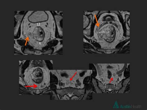 Rectal Mri Pptx