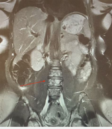 Mri Of The Lumbar Spine Without Contrast Showing Diffuse Lytic Lesions Download Scientific