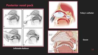 Epistaxis Pptx