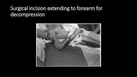 Ppt Compartment Syndrome Powerpoint Presentation Free Download Id