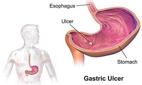 Ulcer Wikipedia