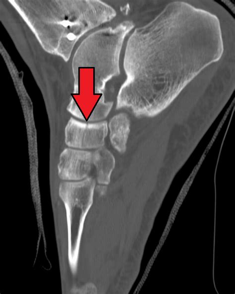 Navicular Fracture Treatment Navicular Bone Fracture Surgery