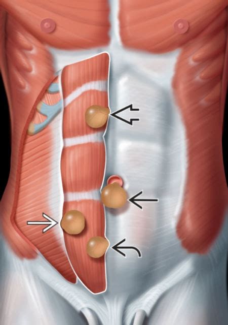 Abdominal Wall Hernias Odia Clinics