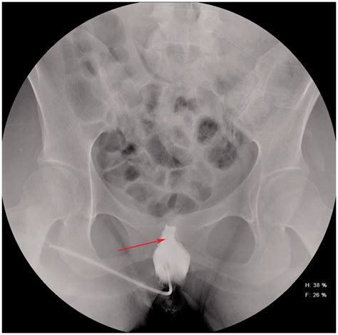 Cystography Shows A Small Capacity Of The Bladder And Tower Like Shape