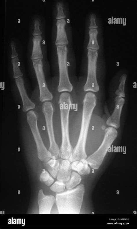 X Ray Hand Normal