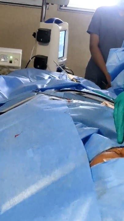 Debrider Auto Rotate Issue And Its Reason Ipc Medtronic Debrider