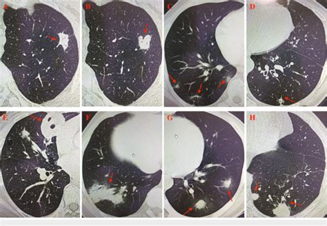 Chest Ct Of The Patients A Nodule With Spicule Sign In The Left Upper