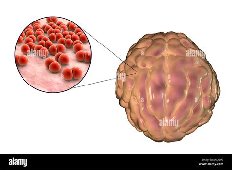 Meningitis Caused By The Bacterium Streptococcus Pneumoniae Computer