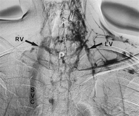 Topographic Anatomy Of The Vertebral Venous System In The Thoracic