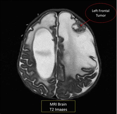 Case Studies Series Multiple Hemangiomas Neurosurgeons Located In