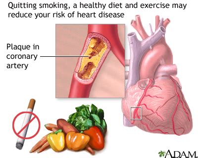 Atherosclerosis Medlineplus Medical Encyclopedia