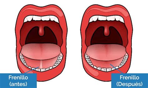 Frenillo Lingual Y Anquiloglosia Clínica Dental Carralero