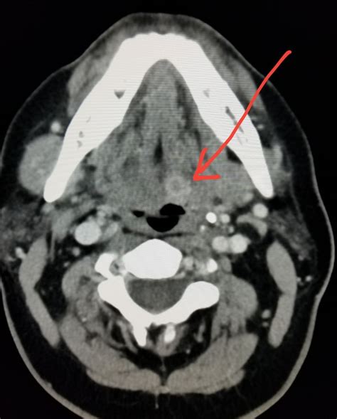 Face Ct Shows Thyroid Tissue That Developed In The Wrong Location