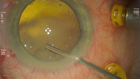 Management Dropped Lens Using Vitrectomy Probe Youtube