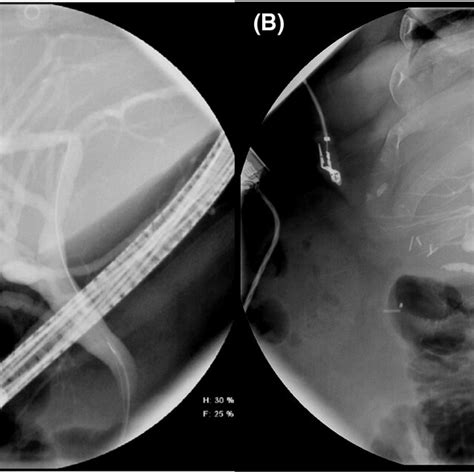 A Preoperative Ercp With Irregular Contrast Filling Near The