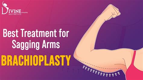 Left Arm Swelling