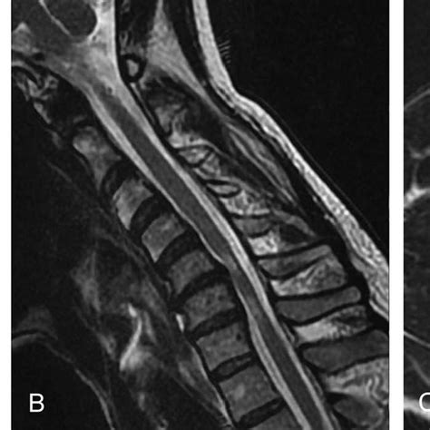 Clinical Outcome Measures For Spinal Muscular Atrophy Type I Download