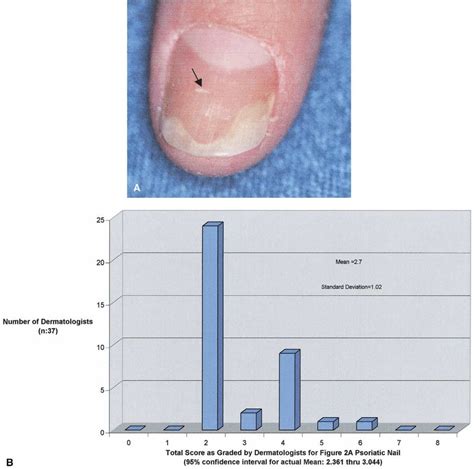 A Example Of Scoring Mild Nail Psoriasis Using The Napsi Grading