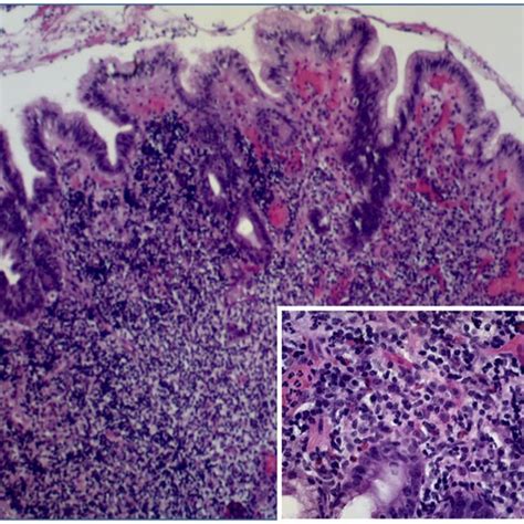 Egd Showed A Large Posterior Antral Wall Ulcer With Heaped Up Edges And