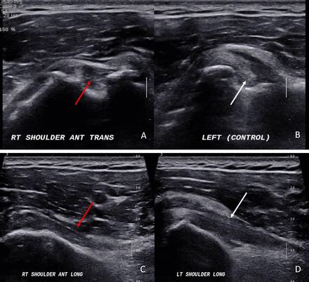 Popeyes Sign Biceps Tendon Rupture Bmj Case Reports