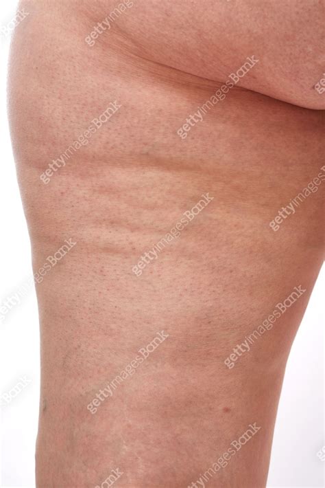 Legs And Buttocks Of A 40 Year Old Woman With Stretch Marks Cellulite