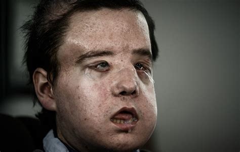 Death Of Jérôme Hamon The Man With Two Face Transplants Archyde