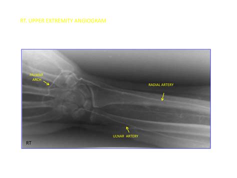 Ppt Radiology Anatomy Of Upper Limb Practical Insights And Imaging