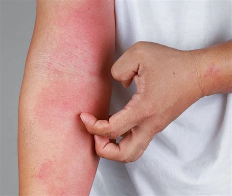 Dermatitiseczema — Ascot Dermatology Dr Laura Wheller Brisbane