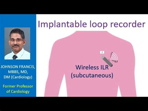 A Guide To Your Implantable Loop Recorder Oadj