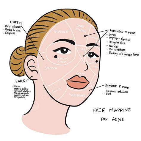 Acne Diagram Of The Face