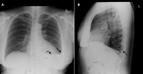 Frontal A And Lateral B Chest Radiographs Of A 55 Year Old Woman