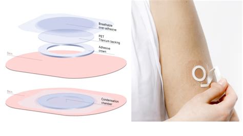 Epicutaneous Immunotherapy Epit