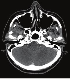 Ct Scan Axial Section Shows An Irregular Hypodense Lesion In The