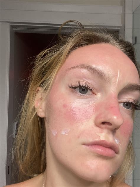 Malar Rash Rautoimmune