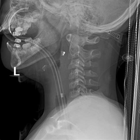 Atlanto Occipital Joint Xray