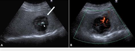 Liver Mass A Us Exam Shows Diffuse Hyperechogenic Fatty Liver