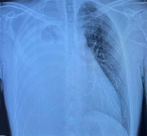 Hematothorax R Medizzy