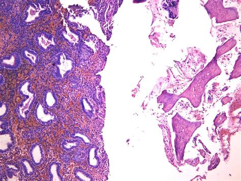 Showing Secretory Endometrium With Heterotopic Bone Formation